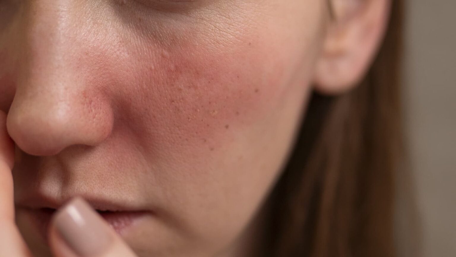 Piel rosácea: causas, síntomas y tratamientos para controlarla